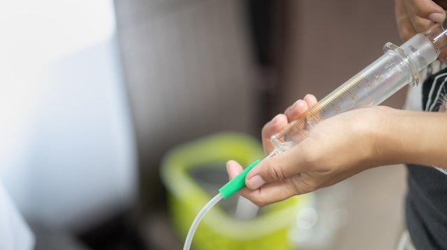 How to Flush a Feeding Tube: A Step-by-Step Guide for Parents and ...