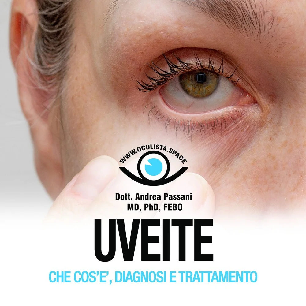 Uveite: cause, diagnosi e trattamento | Oculista Dott. Andrea Passani
