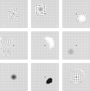 Il Test di Amsler nelle maculopatie | Oculista Dott. Andrea Passani