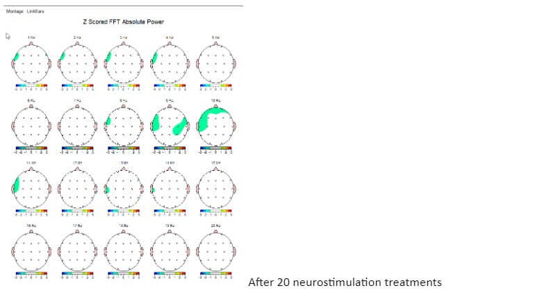 What are brain maps? | Foothills Integrative