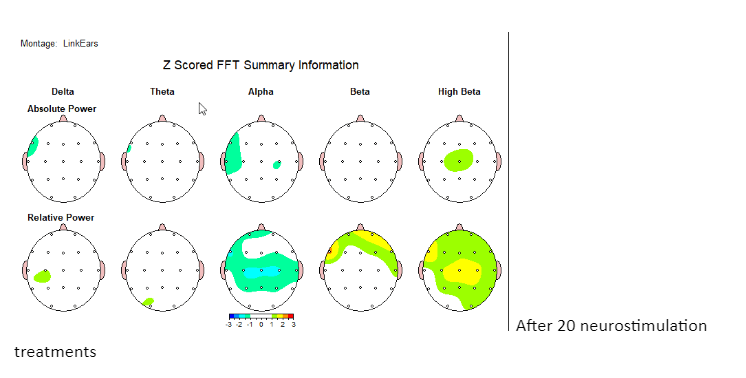 What is Concussion, It’s symptoms & treatment | Foothills Integrative