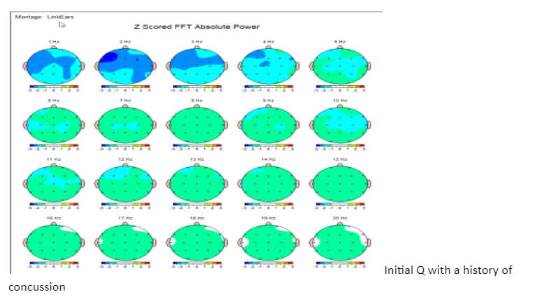 What are brain maps? | Foothills Integrative