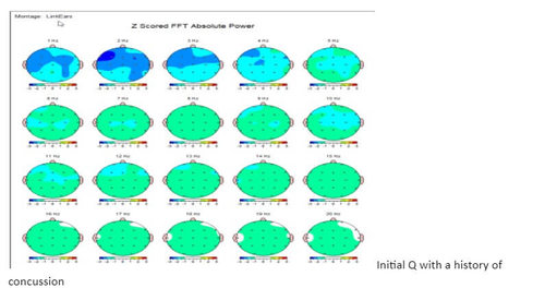 What are brain maps? | A detailed practical overview — Foothills ...