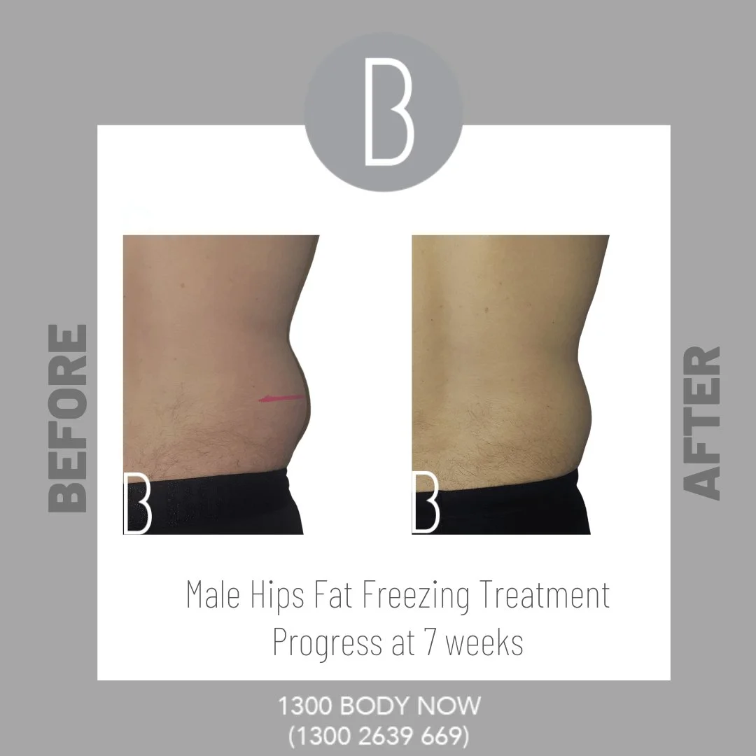 Fat freezing for Men better than CoolSculpting
