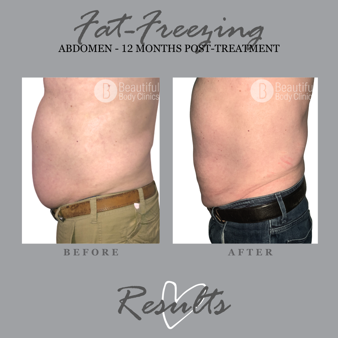 Fat freezing for Men | CoolSculpting Services