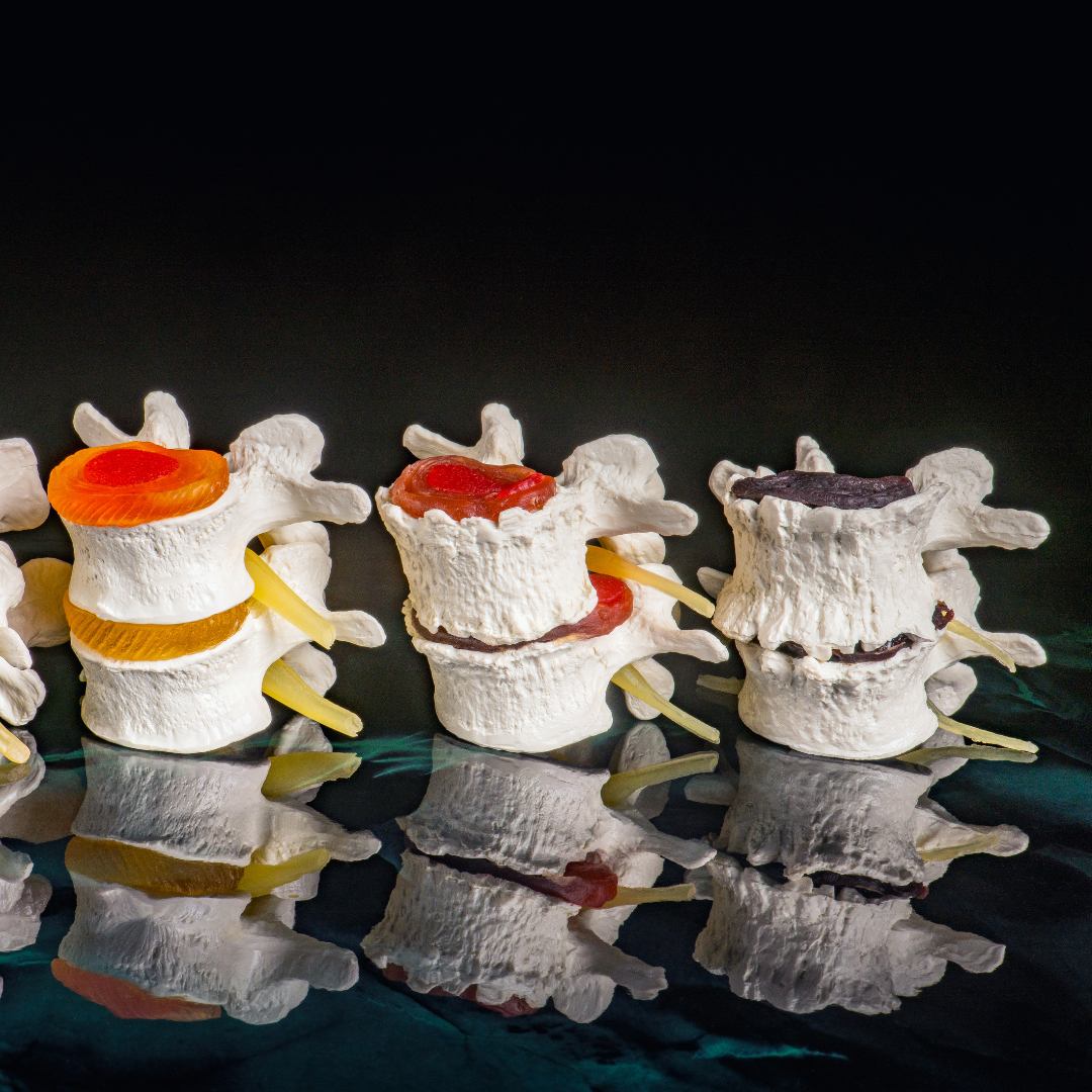 The Disc Doctors-Degenerative Disc Disease