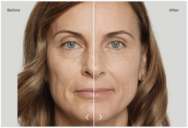 Sculptra Injections to Revitalize Your Skin — Modern Medspa | Hooksett, NH