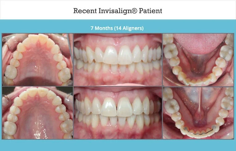 Invisalign — Meyer Orthodontics