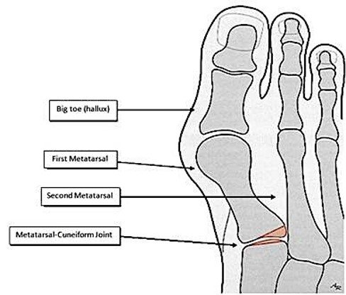 The painful bunion — Tonya An, MD