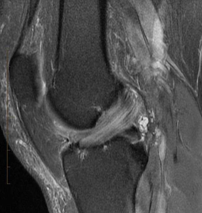 Dégénérescence mucoïde du ligament croisé antérieur (LCA) : une cause ...