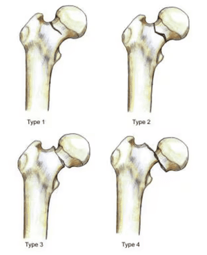 Fractures du Col du Fémur : Diagnostic, Classification et Traitements ...