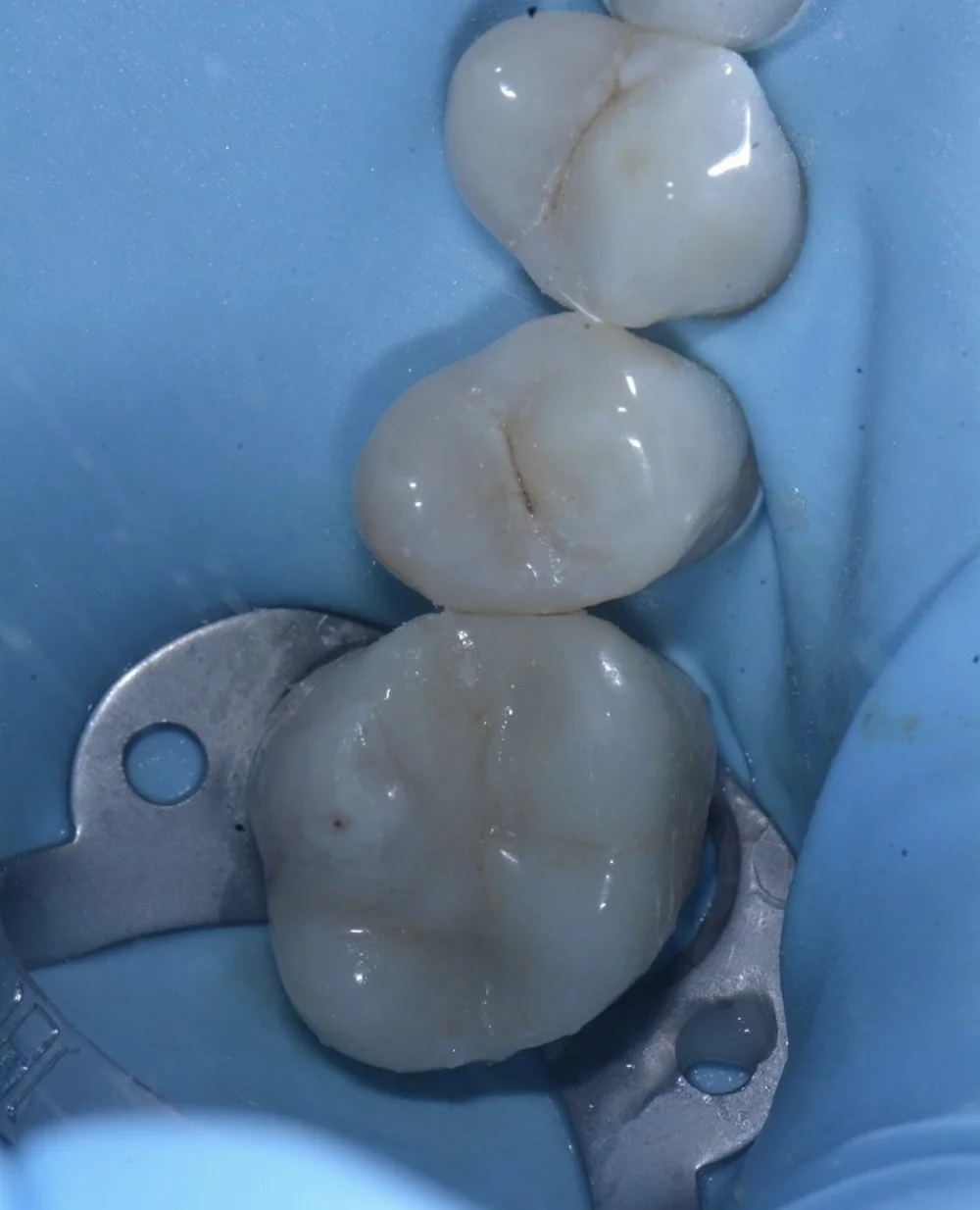 Examples of Work — Alleman Dental