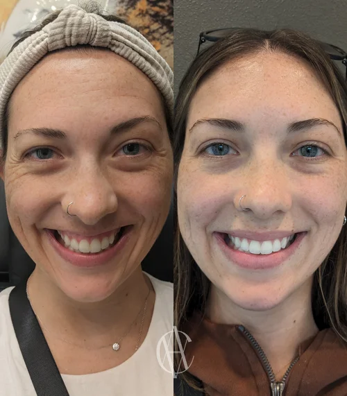 Lip Flip vs Lip Filler: Which One is Best for You? — ⬦ A-Class Aesthetics