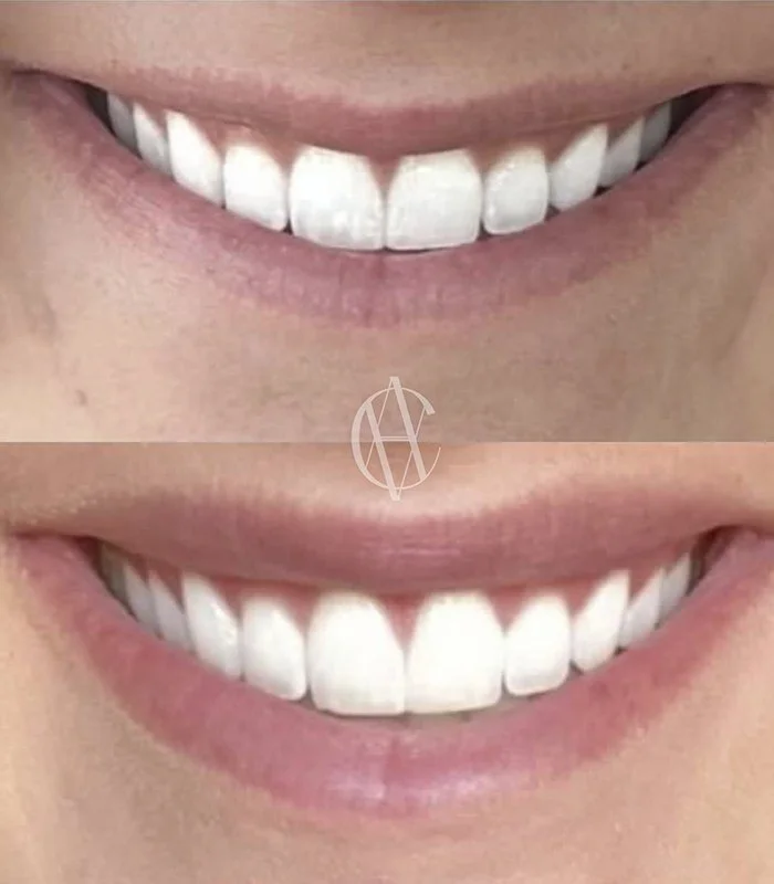 Lip Flip Botox Milwaukee — ⬦ A-Class Aesthetics