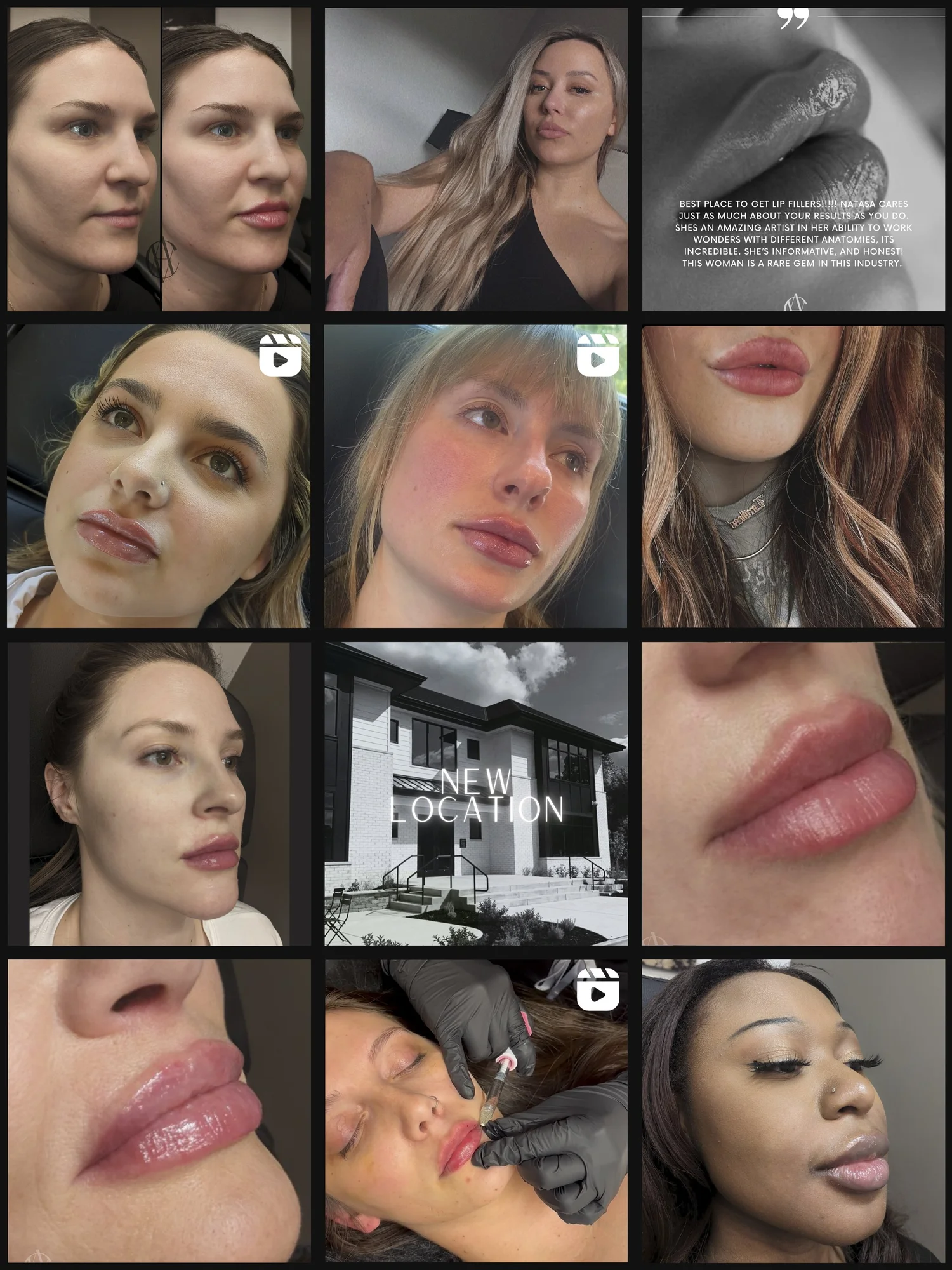 Lip Flip vs Lip Filler: Which One is Best for You? — ⬦ A-Class Aesthetics