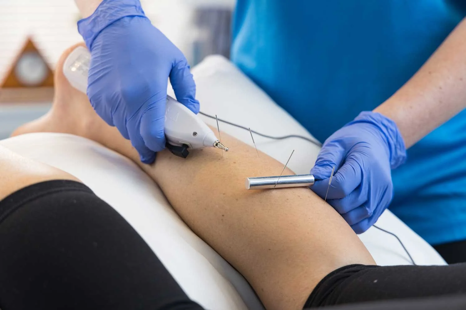 Dry Needling | Bull Dawg Athletic Training & Physical Therapy