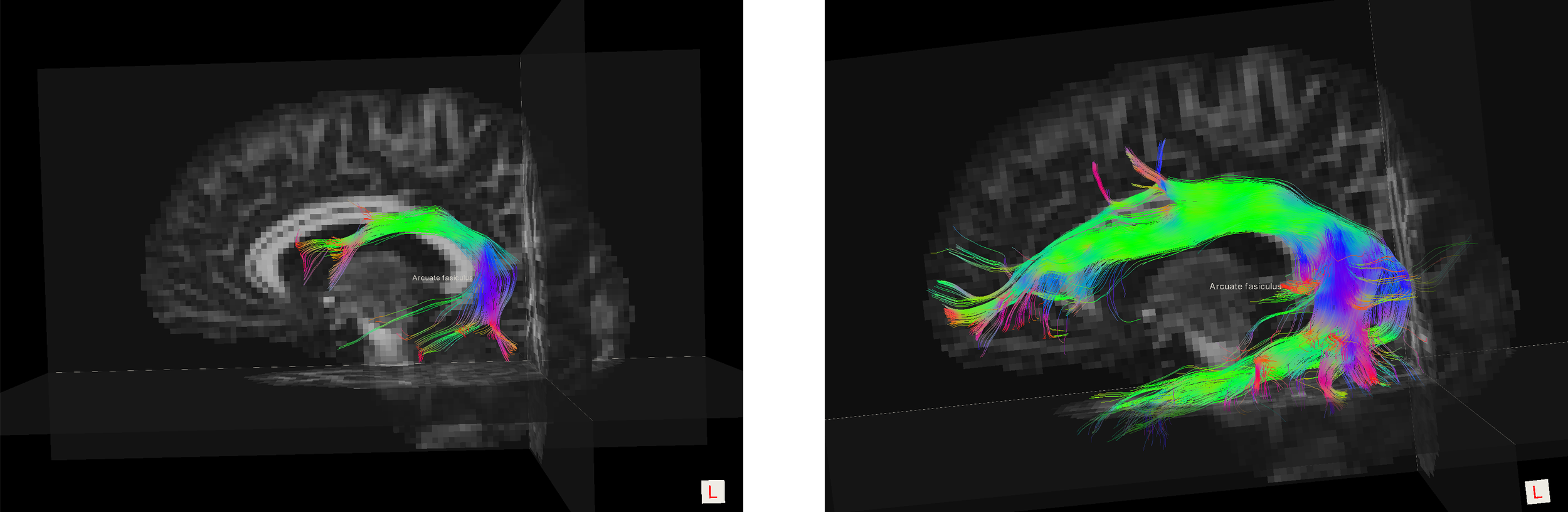 Diffusion and Tractography — nordicMEDiVA