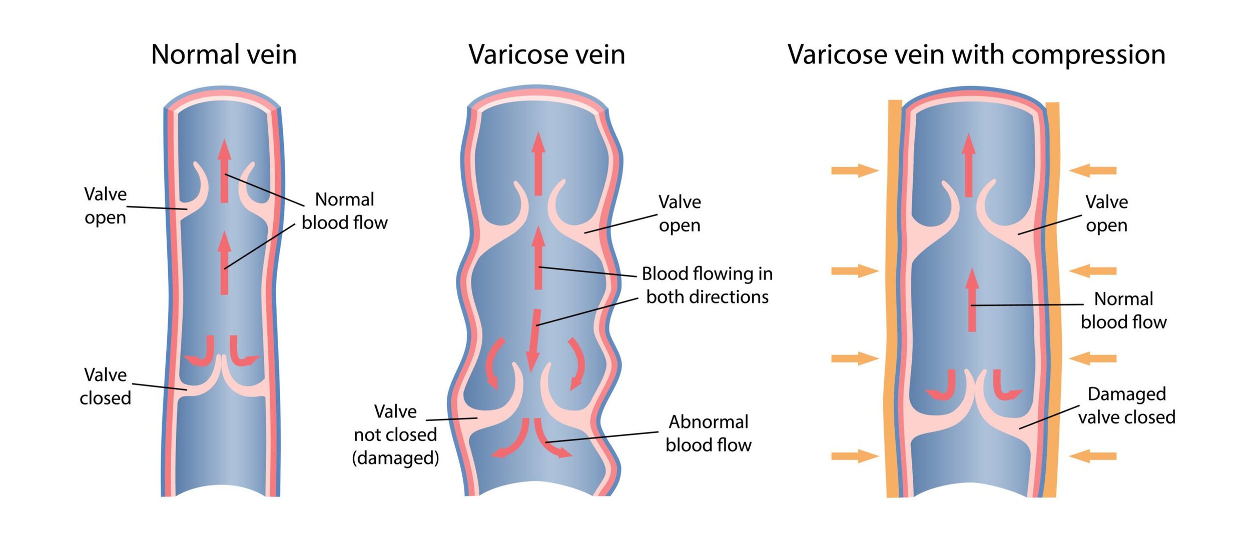 Varicose Veins — Vascular Cures