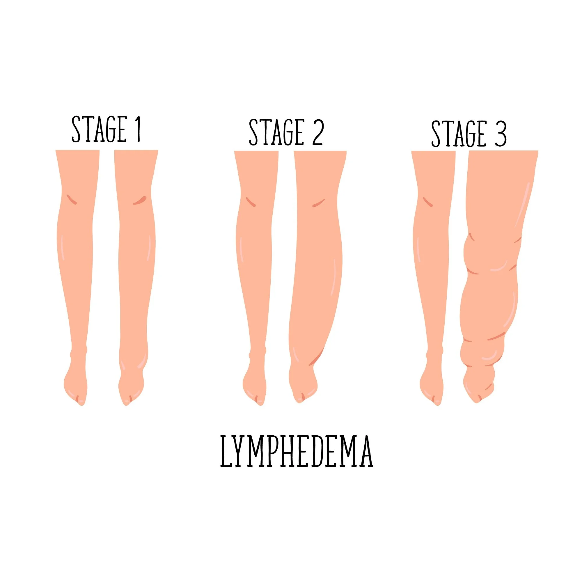 Lymphedema