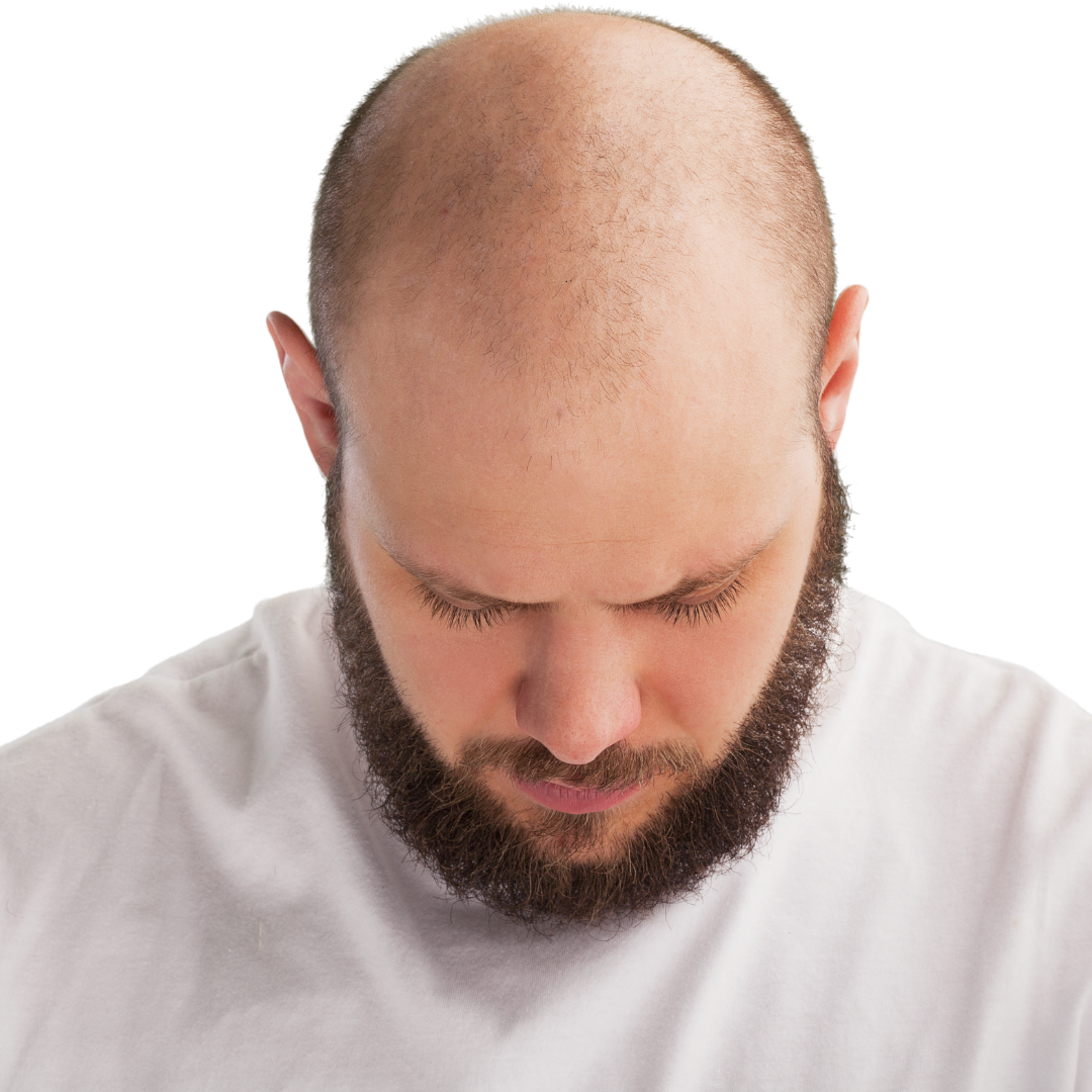 Horseshoe Pattern Baldness