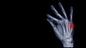 How Do You Treat a Boxer's Fracture? — Ortho San Antonio
