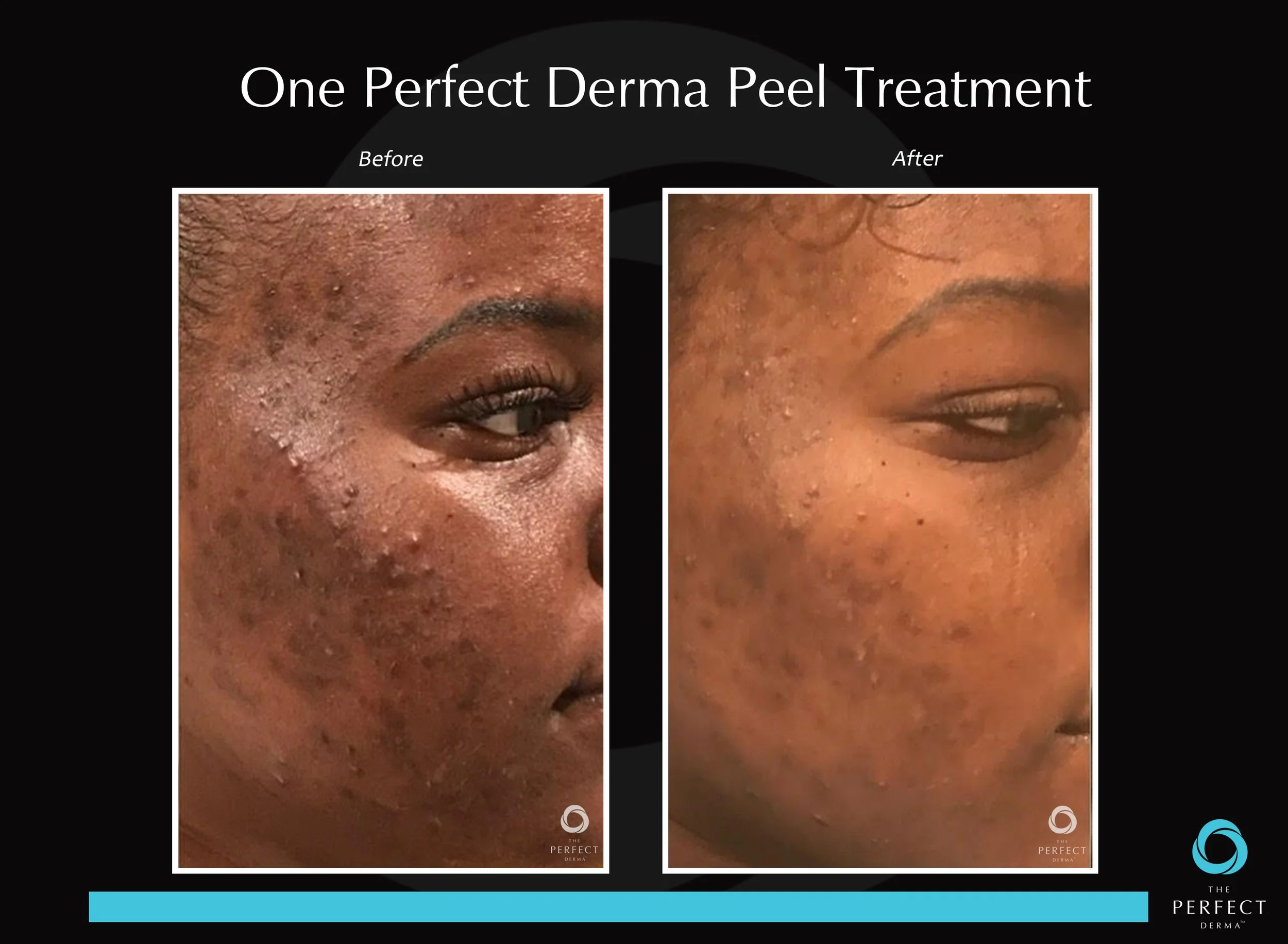 chemical peels — HRA Skin: An Acne Clinic