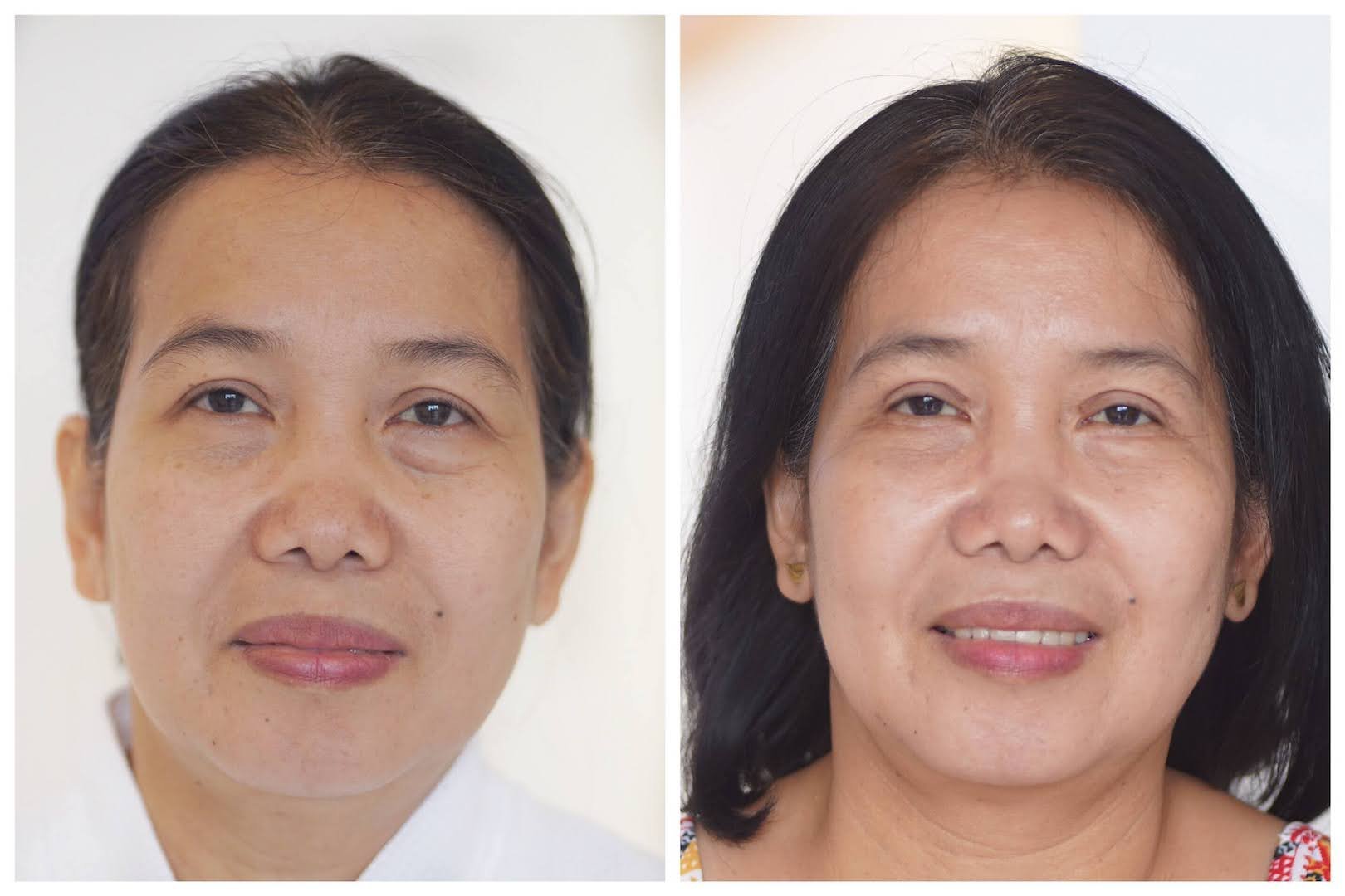 Age-control Surgery — PRHINA Rhinoplasty and Age Control Clinic