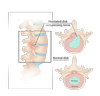 A Physio’s Guide To Lumbar Disc Bulges - How to Know if You Have One ...