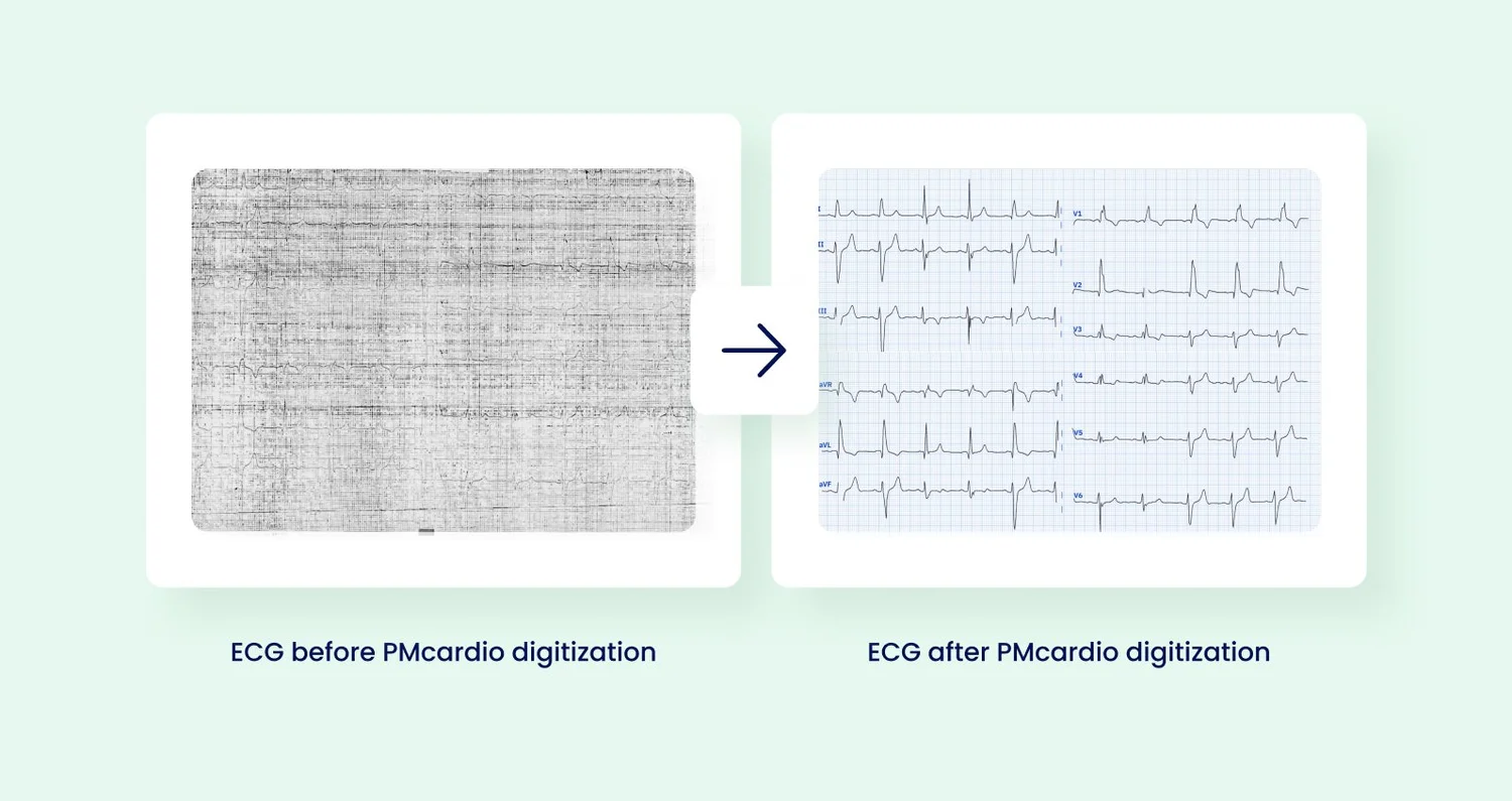 How to improve the quality of an ECG instantly (with examples ...