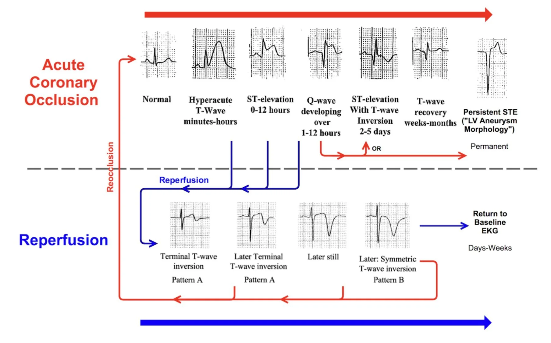 Occlusion Myocardial Infarction (OMI): Importance, Recognition, and ...