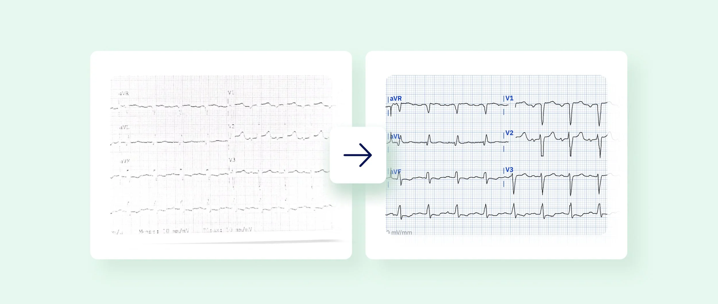 How to improve the quality of an ECG instantly (with examples) — Powerful Medical