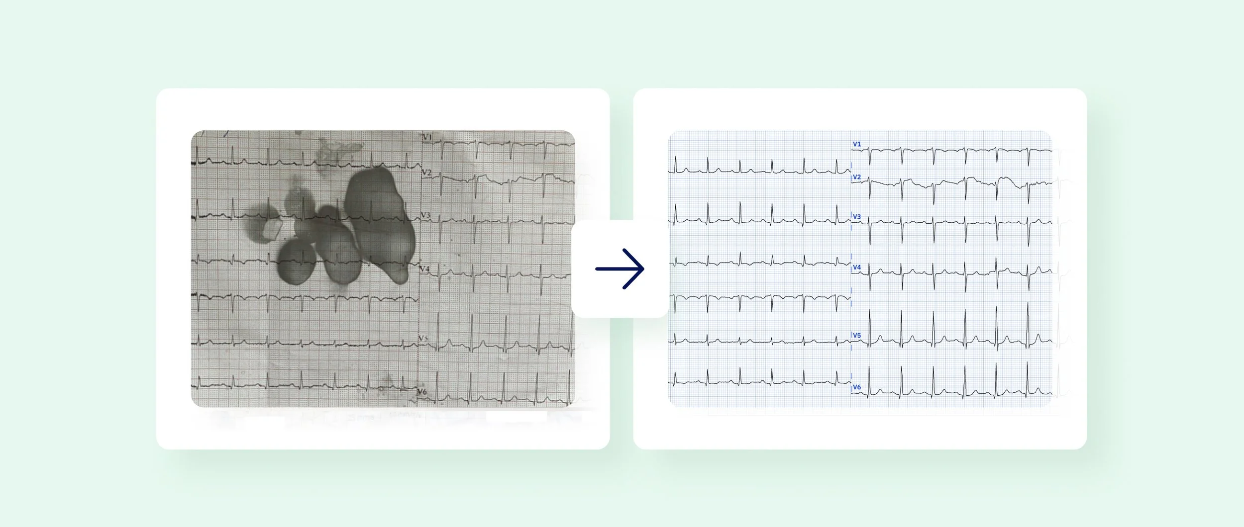 How to improve the quality of an ECG instantly (with examples ...