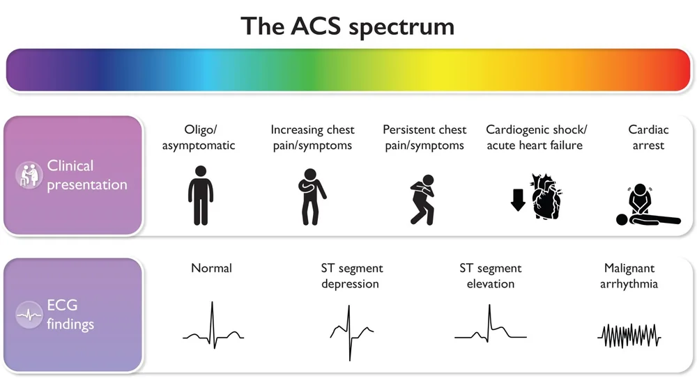 ACS Guidelines 2023: New ESC Update — Powerful Medical
