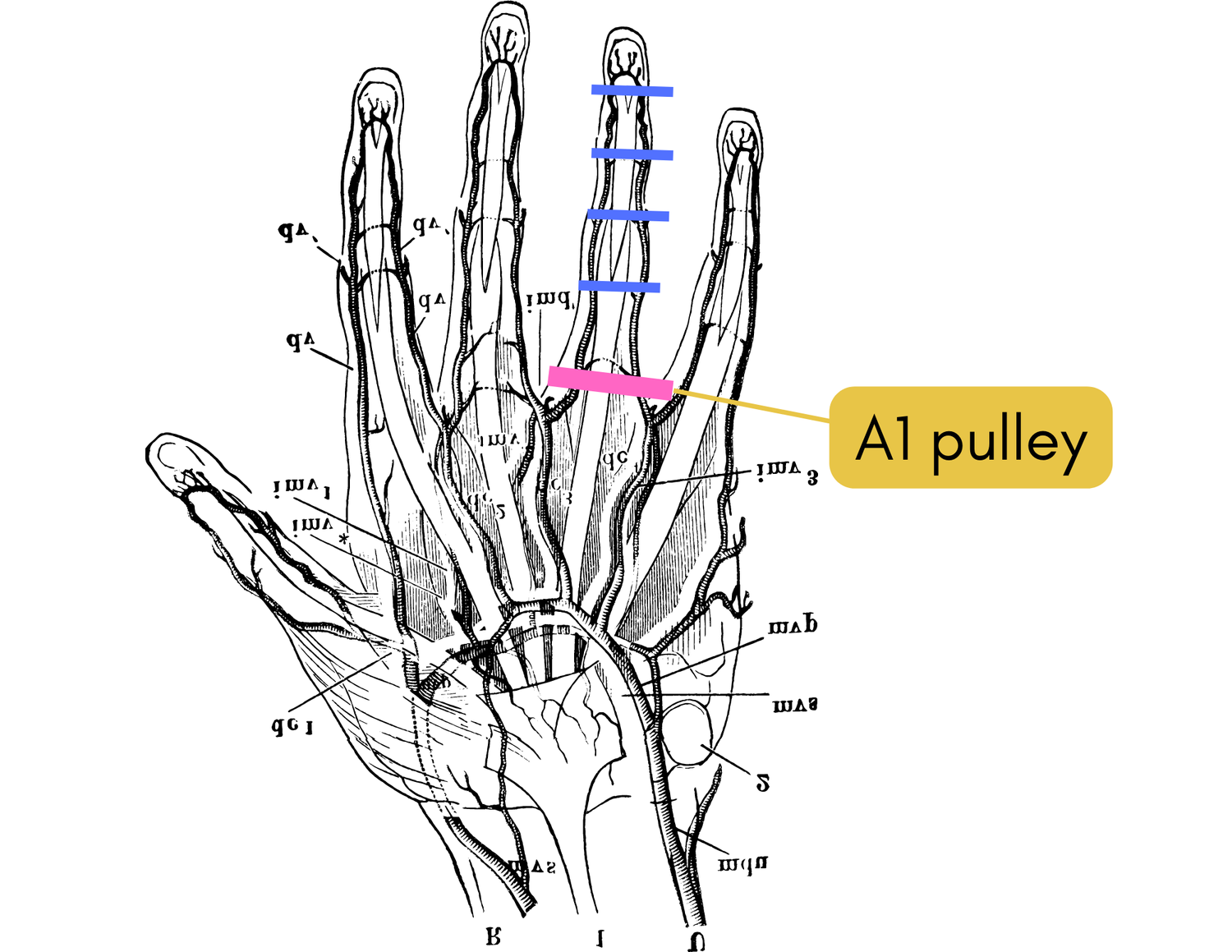 Bust trigger finger with splints & exercises! — Hand Coach Corinne