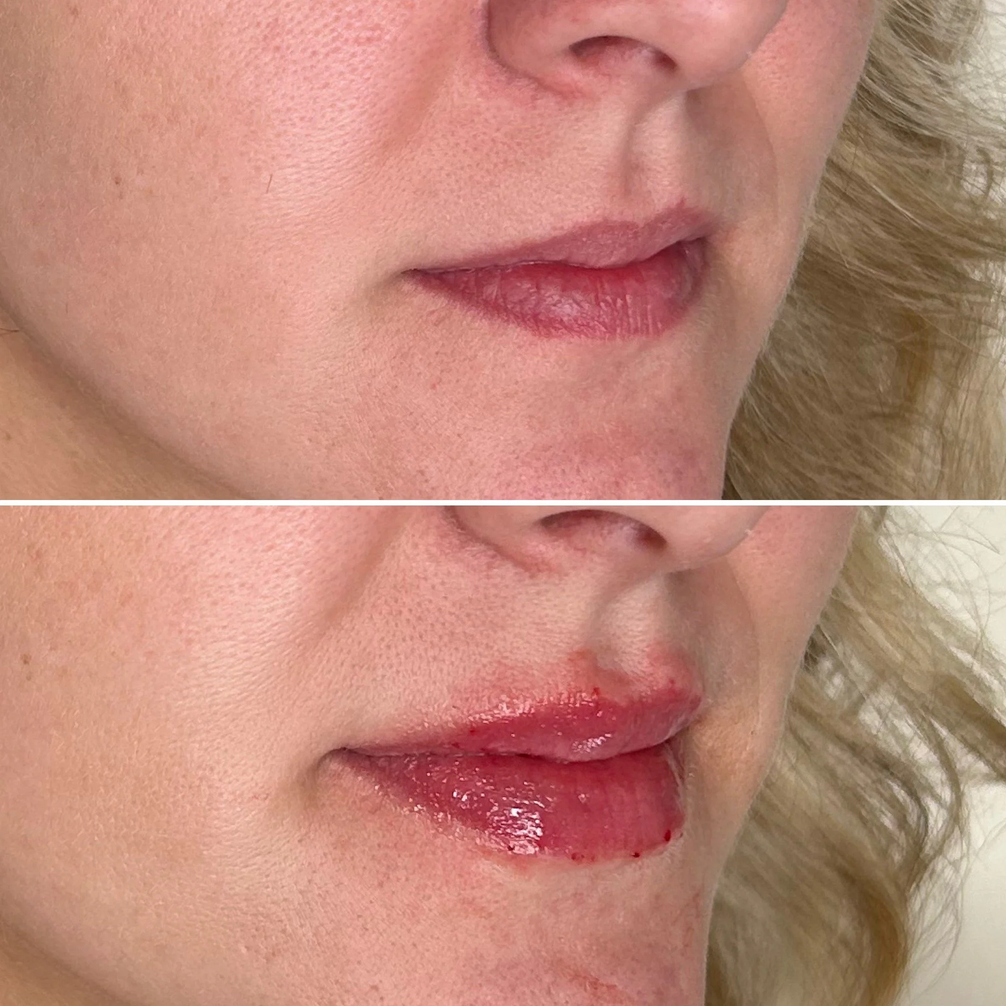 Lip Filler in Flowood MS — Highland Medical & Aesthetics
