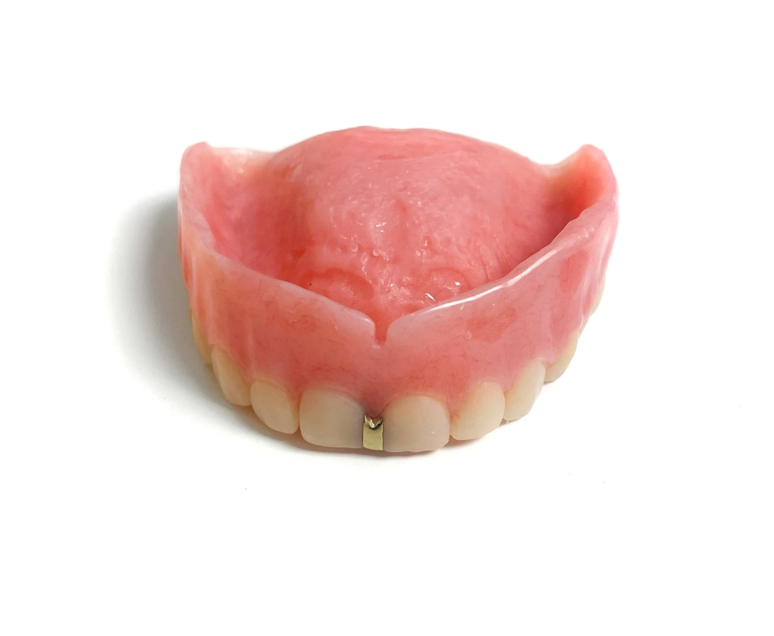 Gold Inlays | Dental Implants Hamilton NZ - HDPL