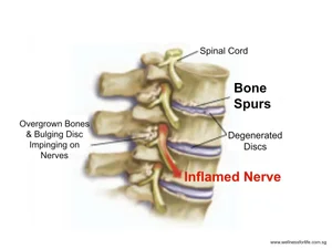 Bones Spurs- Nature’s Way To “Save” Your Spine — Wellness for Life