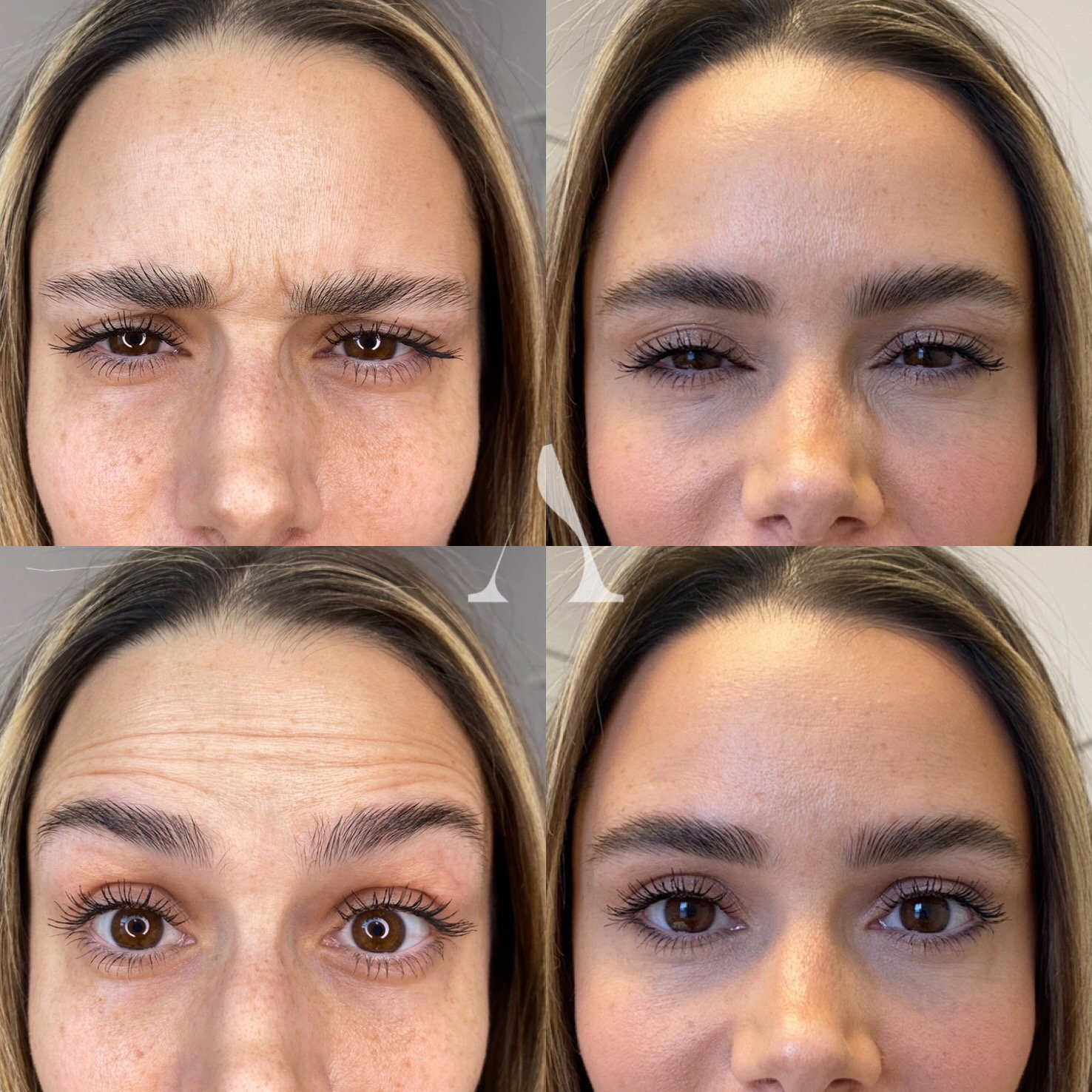 Injectables | Neurotoxin and Filler | Leominster and Southborough MA ...