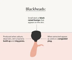 What's the Difference Between Blackheads and Sebaceous Filaments ...