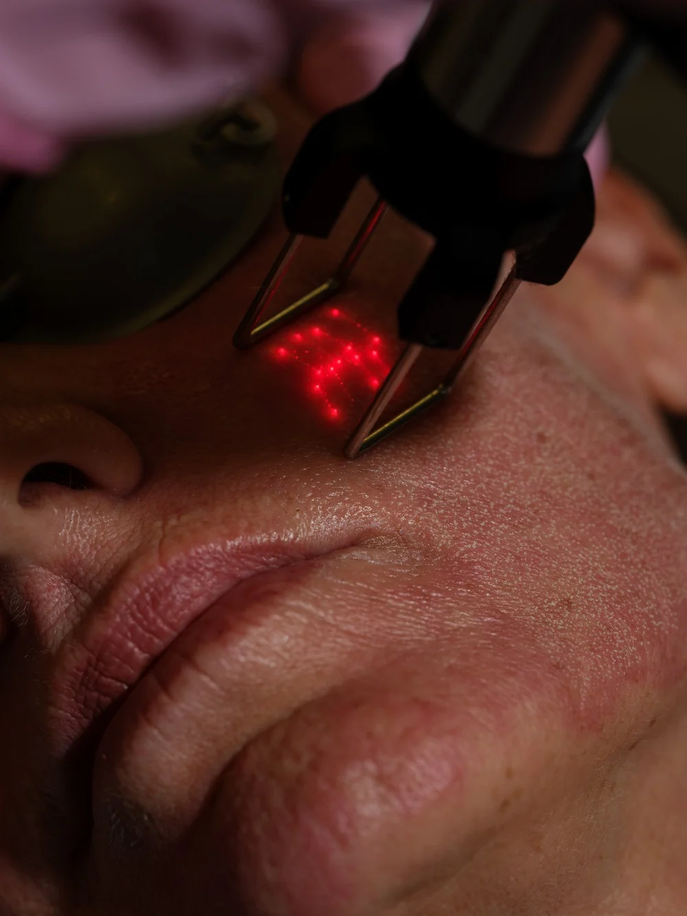 Laser Therapies | Discover Effective Laser Treatments — The Skin RN