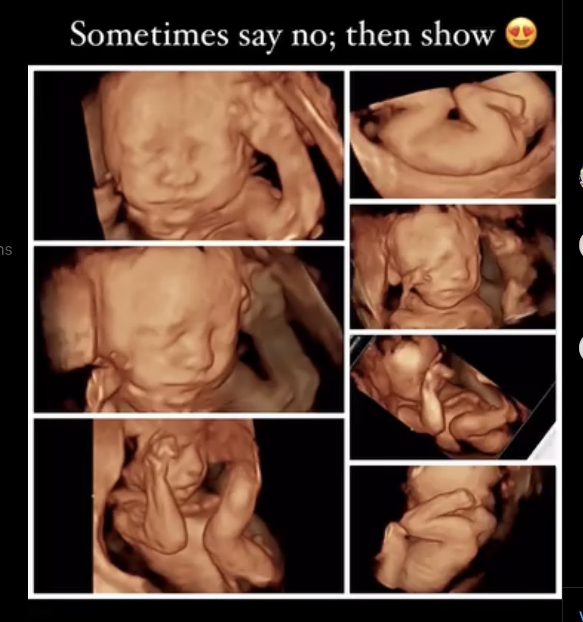 Ultrasound 3D 4D 5D HD Baby Ultrasound Imaging Gender Ultrasound Ultrasound 3D 4D 5D HD Baby Ultrasound Imaging Gender Ultrasound
