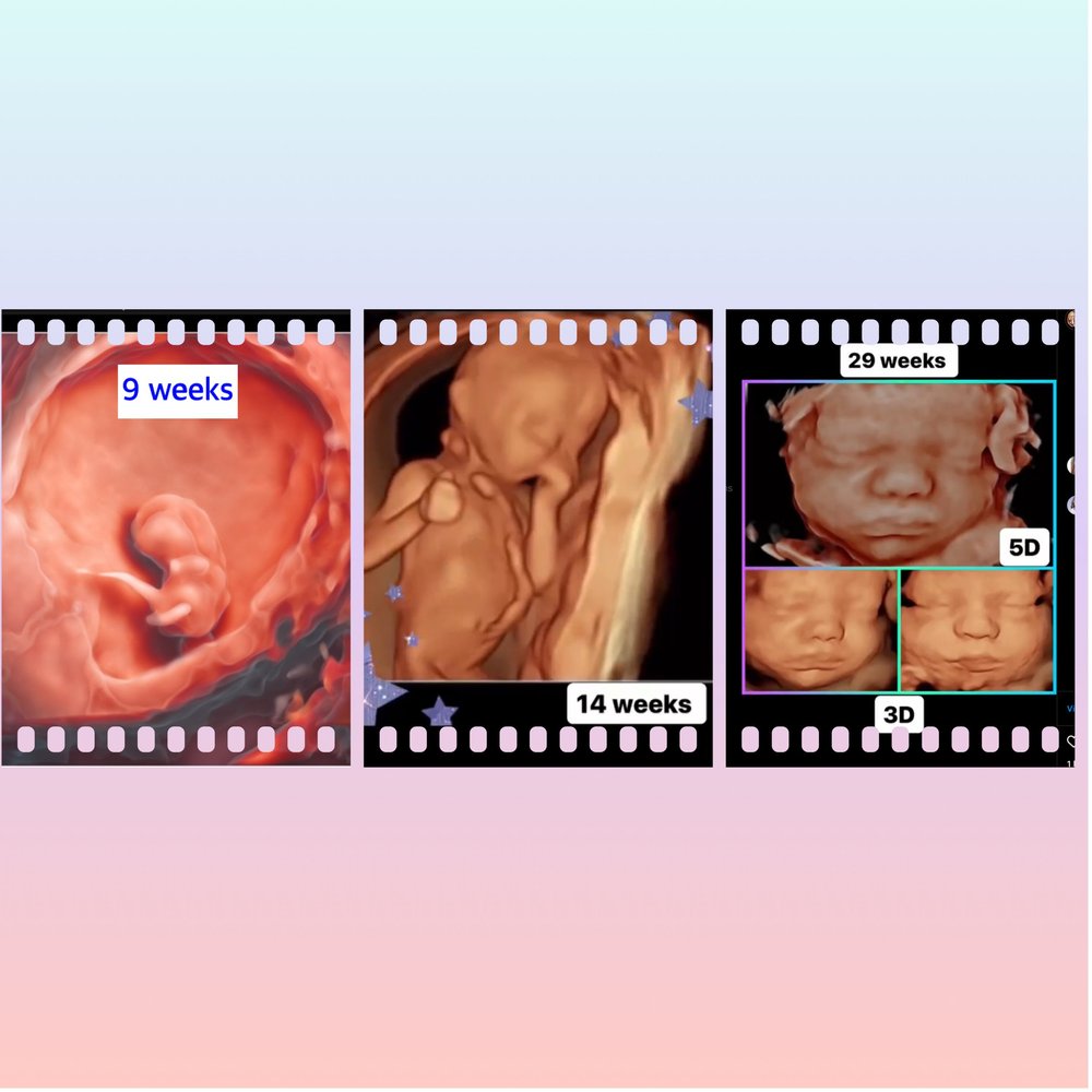 3D 4D 5D HD baby ultrasound imaging. Gender Ultrasound Sonogram. Bebe ...