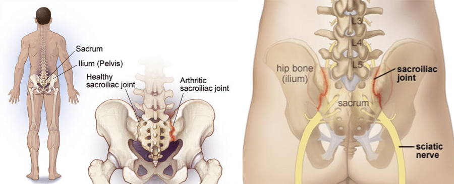 Is it Sciatica or SI joint pain? Toronto — Proactive Pelvic Health Centre