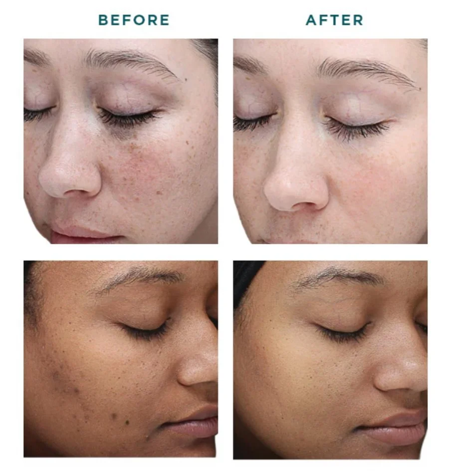 VI Peel Treatments | Acne, Brightening & Anti-Aging Results | HAUS ...