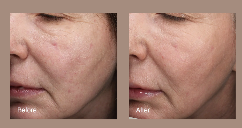 Vivace Ultra RF Microneedling — Forever Young Solutions