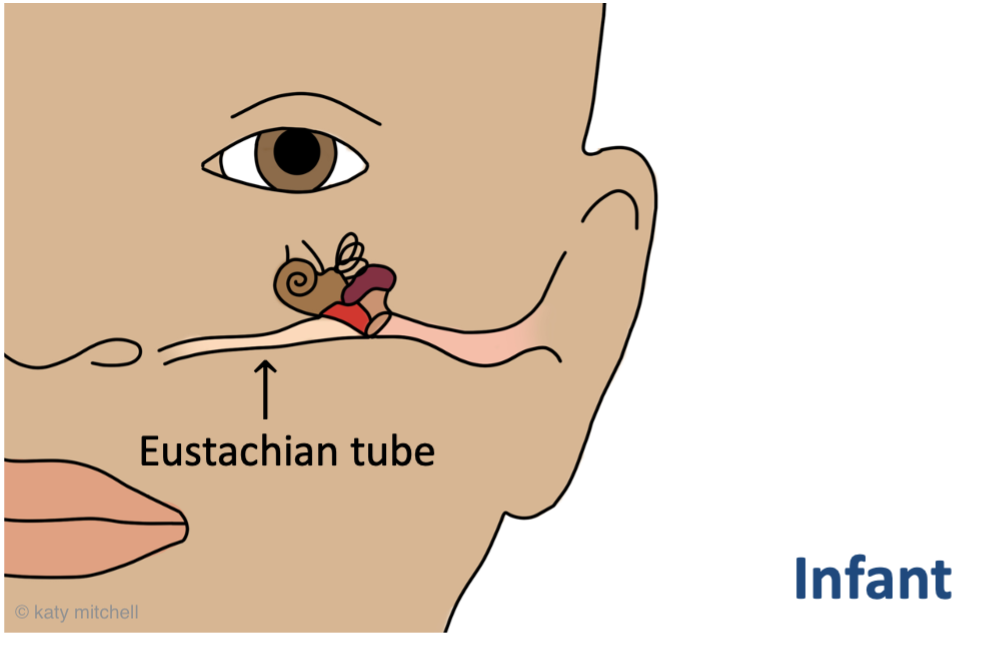 What causes glue ear? — Glue Ear Together