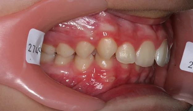 Dental Bite Guide: Types And Treatment Methods Explained