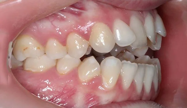 Dental Bite Guide: Types And Treatment Methods Explained