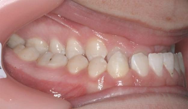 Dental Bite Guide: Types And Treatment Methods Explained