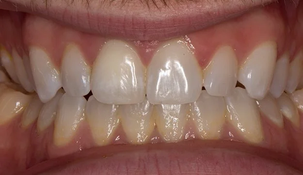 Dental Bite Guide: Types And Treatment Methods Explained